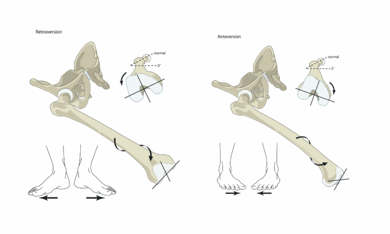 Hip and Knee Pain: The Hidden Role of Your Thigh Bones | Rick Olderman